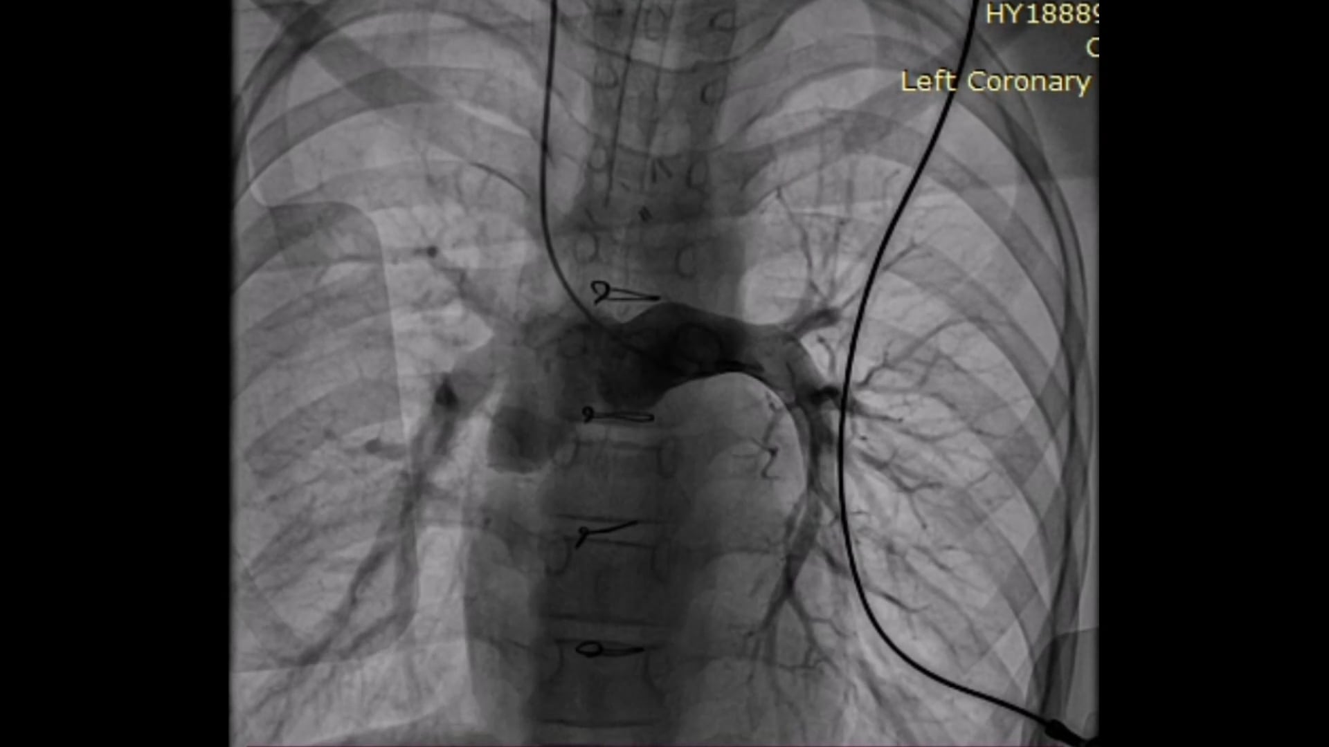 Completion of an interventional extracardiac Fontan | MMCTS