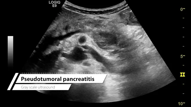 Pancreatitis Ultrasound