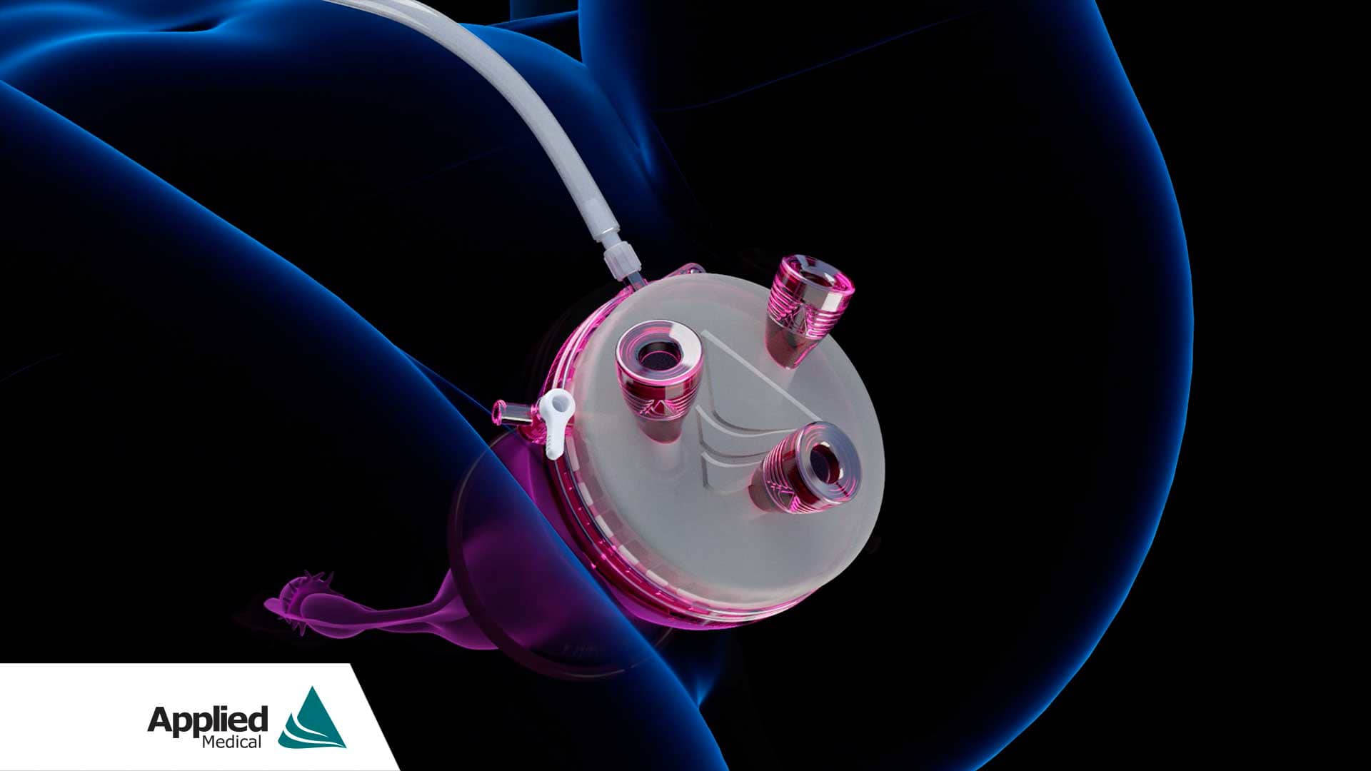 vNOTES Hysterectomy featuring the GelPOINT® V-Path Transvaginal Access ...