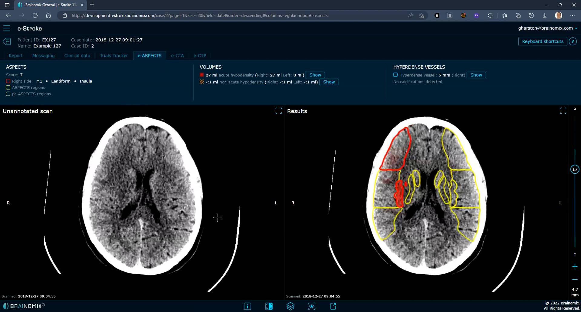 e-Stroke 11.1 Overview on Vimeo