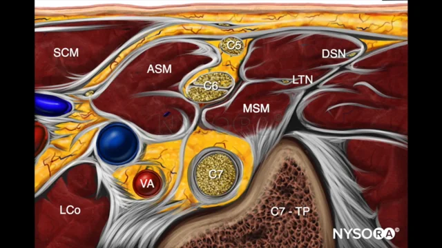 Interscalene Block