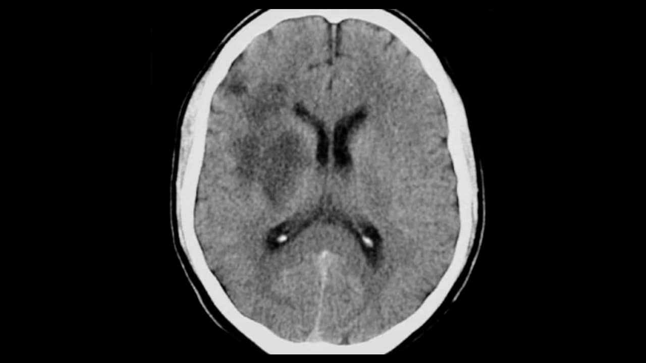 SIGNO DE LA ARTERIA CEREBRAL MEDIA HIPERDENSA o SIGNO DE LA CUERDA on Vimeo