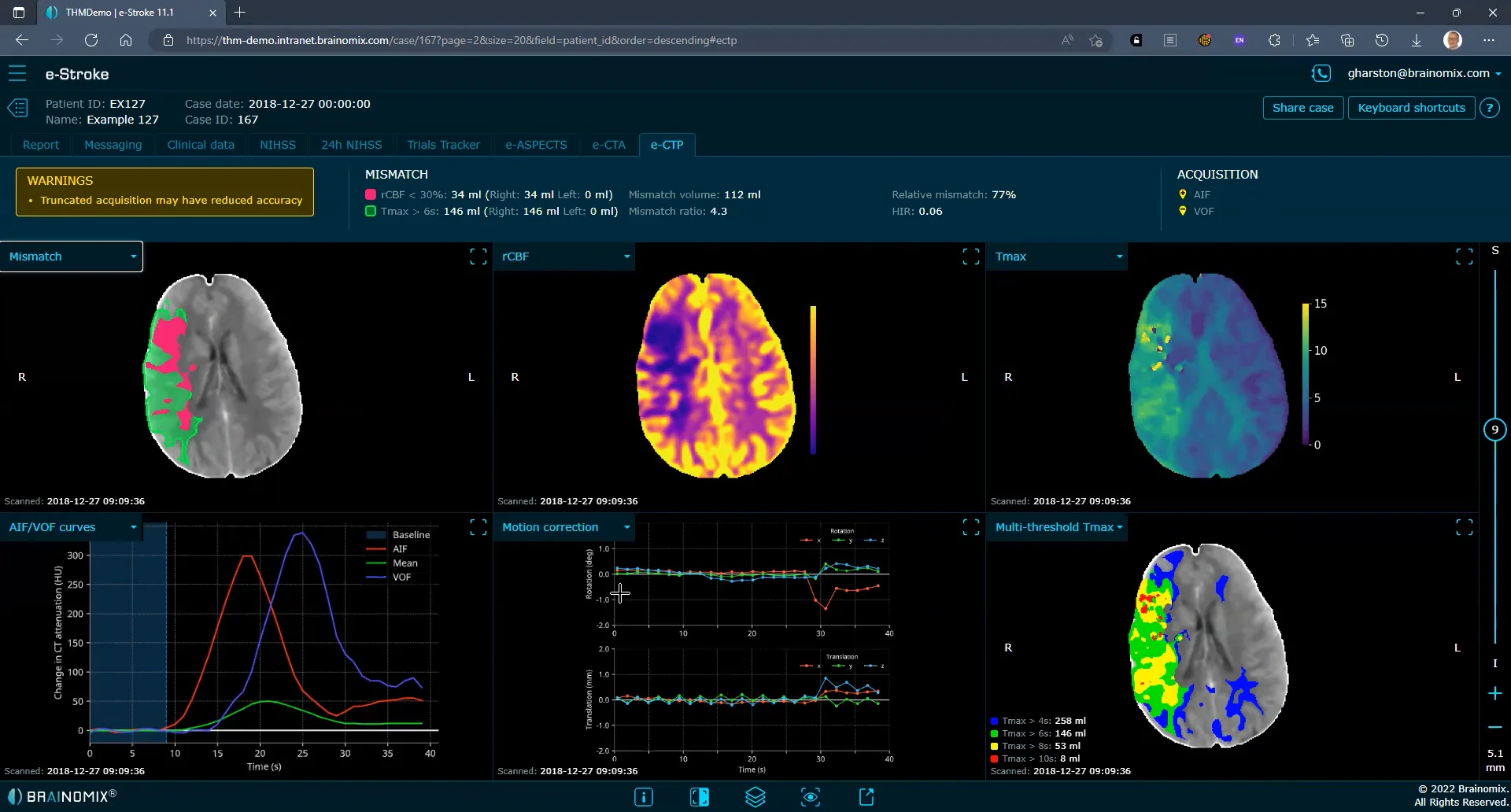 e-Stroke overview Nov22.mp4 on Vimeo