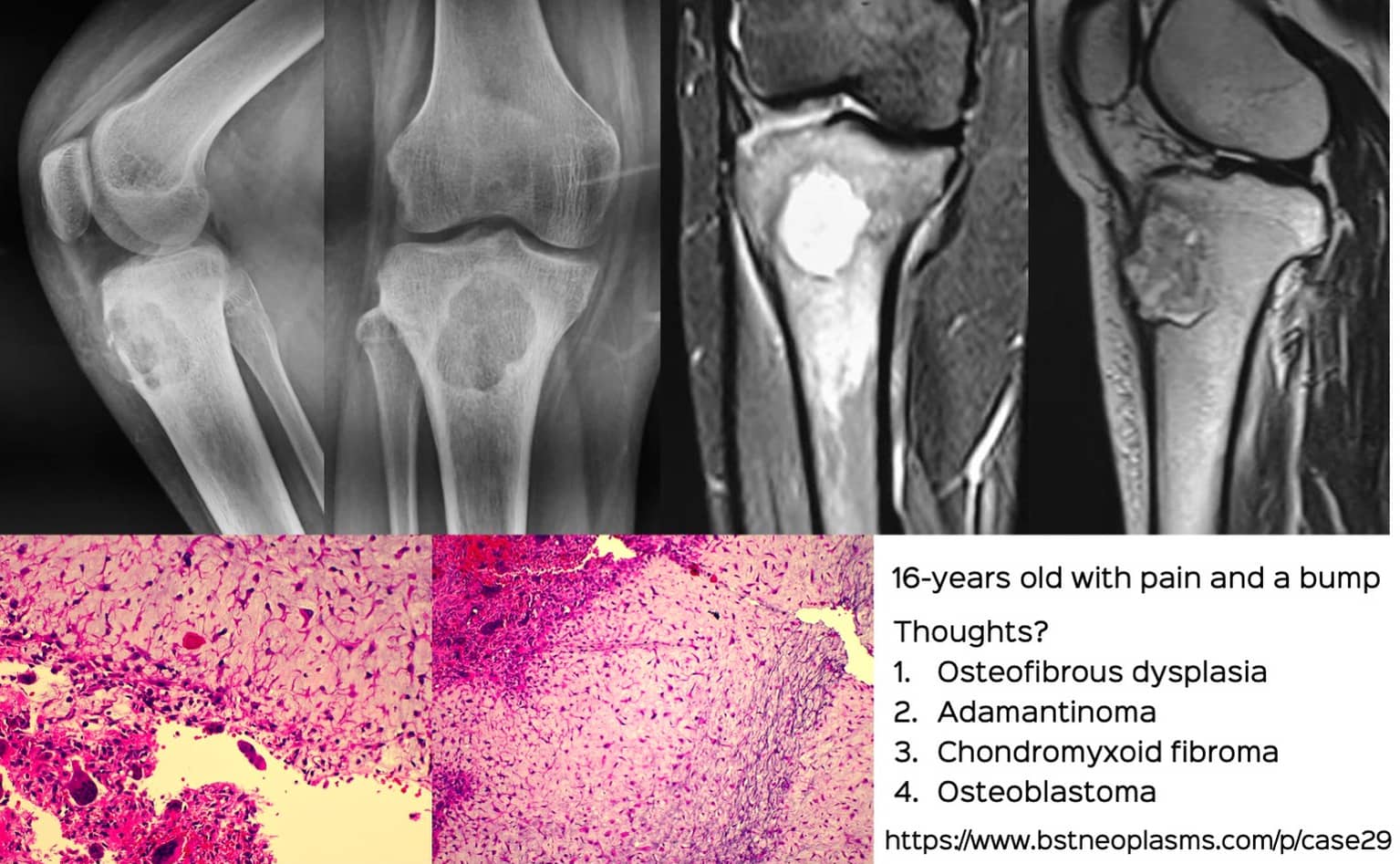 Case 29 - Proximal Tibial Bump.mov on Vimeo
