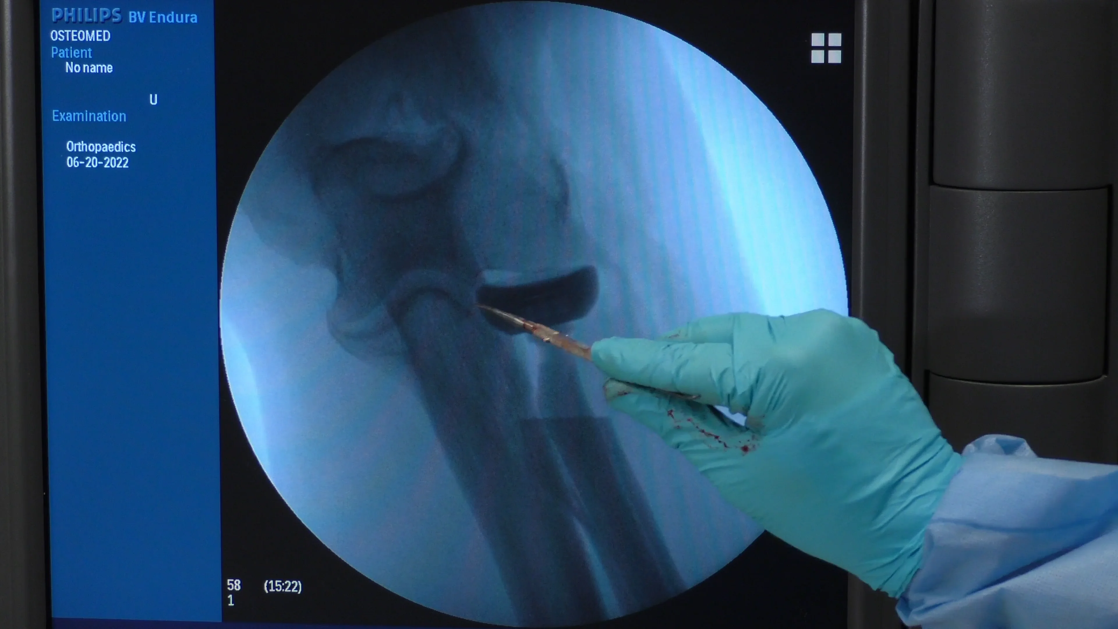 Radial Head Fracture Replacement Using the Long Stem Acumed Anatomic ...