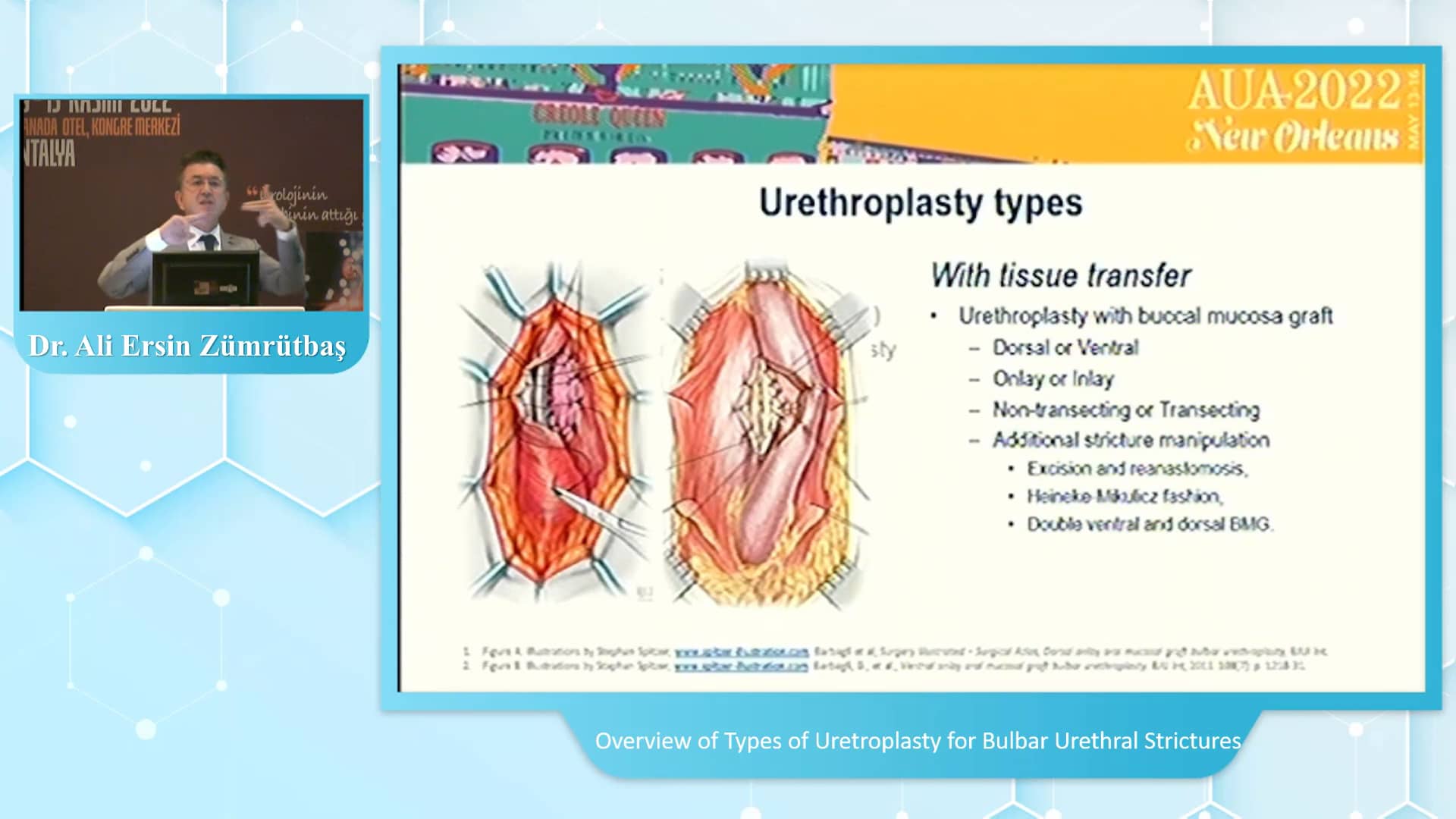 Overview of Types of Uretroplasty for Bulbar Urethral Strictures Dr Ali ...