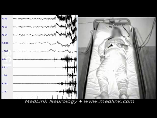 Sleep and parkinsonism | MedLink Neurology
