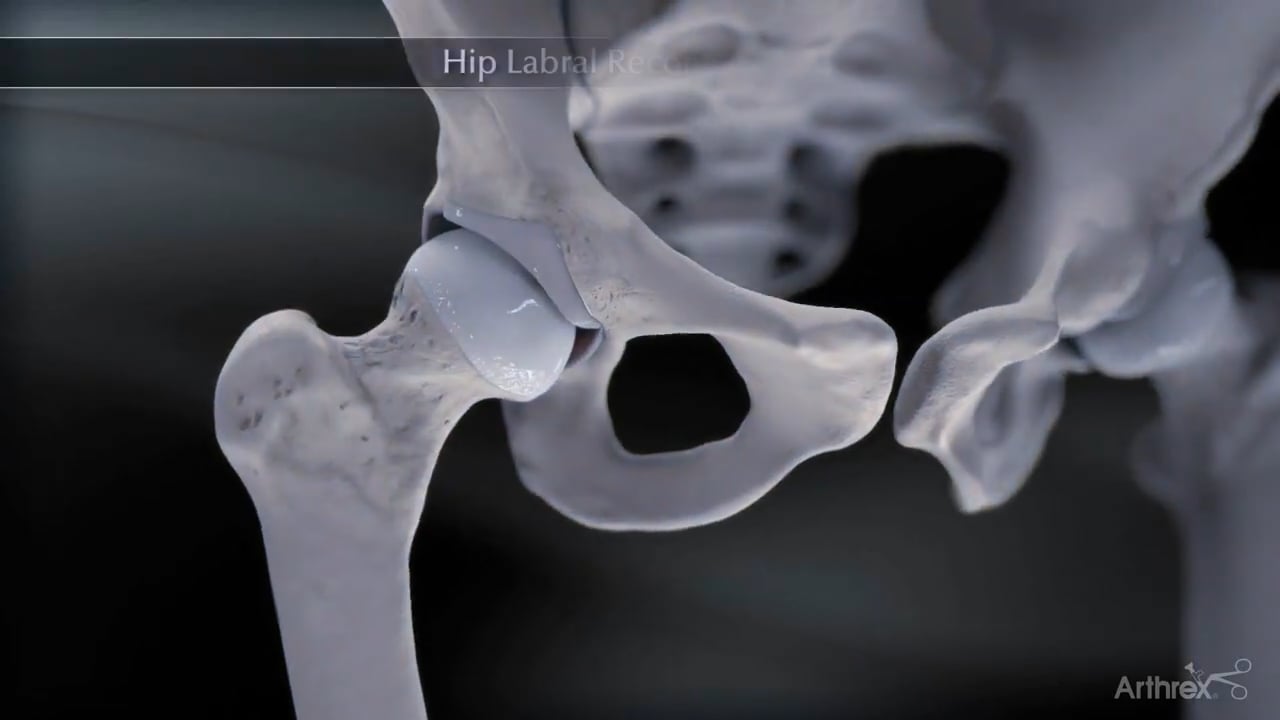 Hip Labral Reconstruction.mp4 on Vimeo