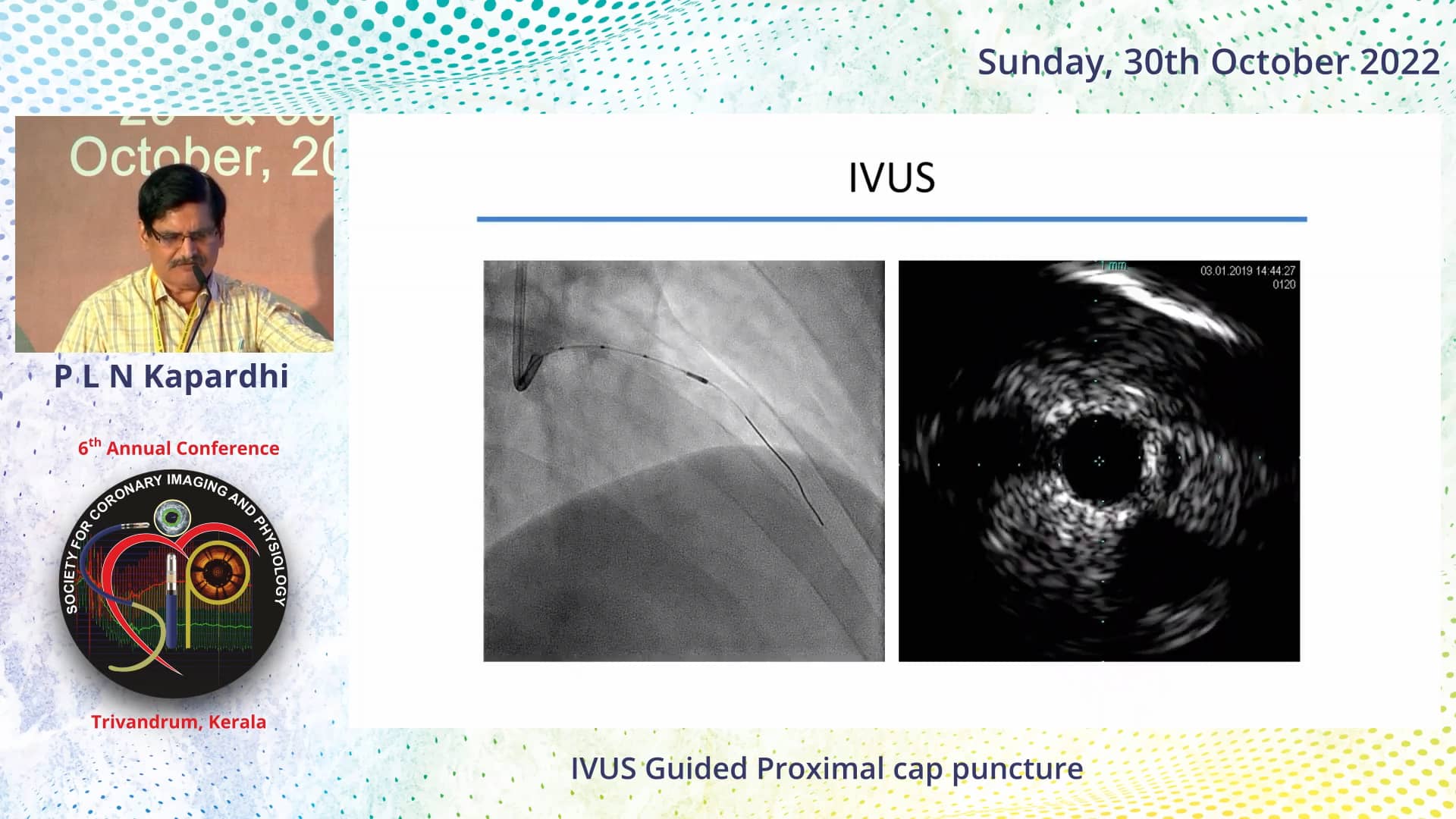 P L N Kapardhi (Ivus Guided Proximal Cap Puncture) on Vimeo