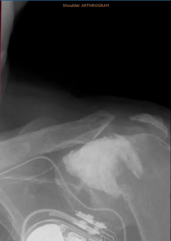 Shoulder Arthogram no Movement on Vimeo