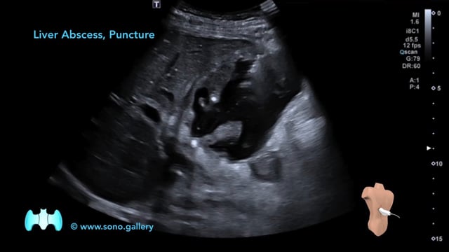 Echinococcus Cyst - SONO.GALLERY