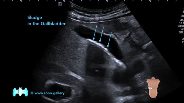 Gallbladder Ultrasound Sludge