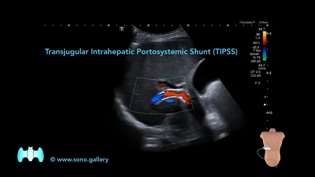 Transjugular Intrahepatic Portosystemic Shunt Ultrasound