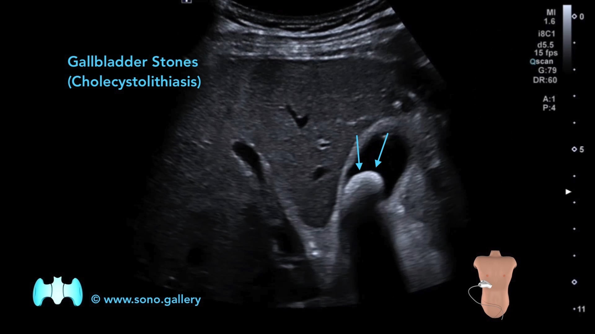 Gallbladder Stones (Cholecystolithiasis) on Vimeo