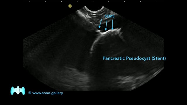 Pancreatic Pseudocyst Ultrasound