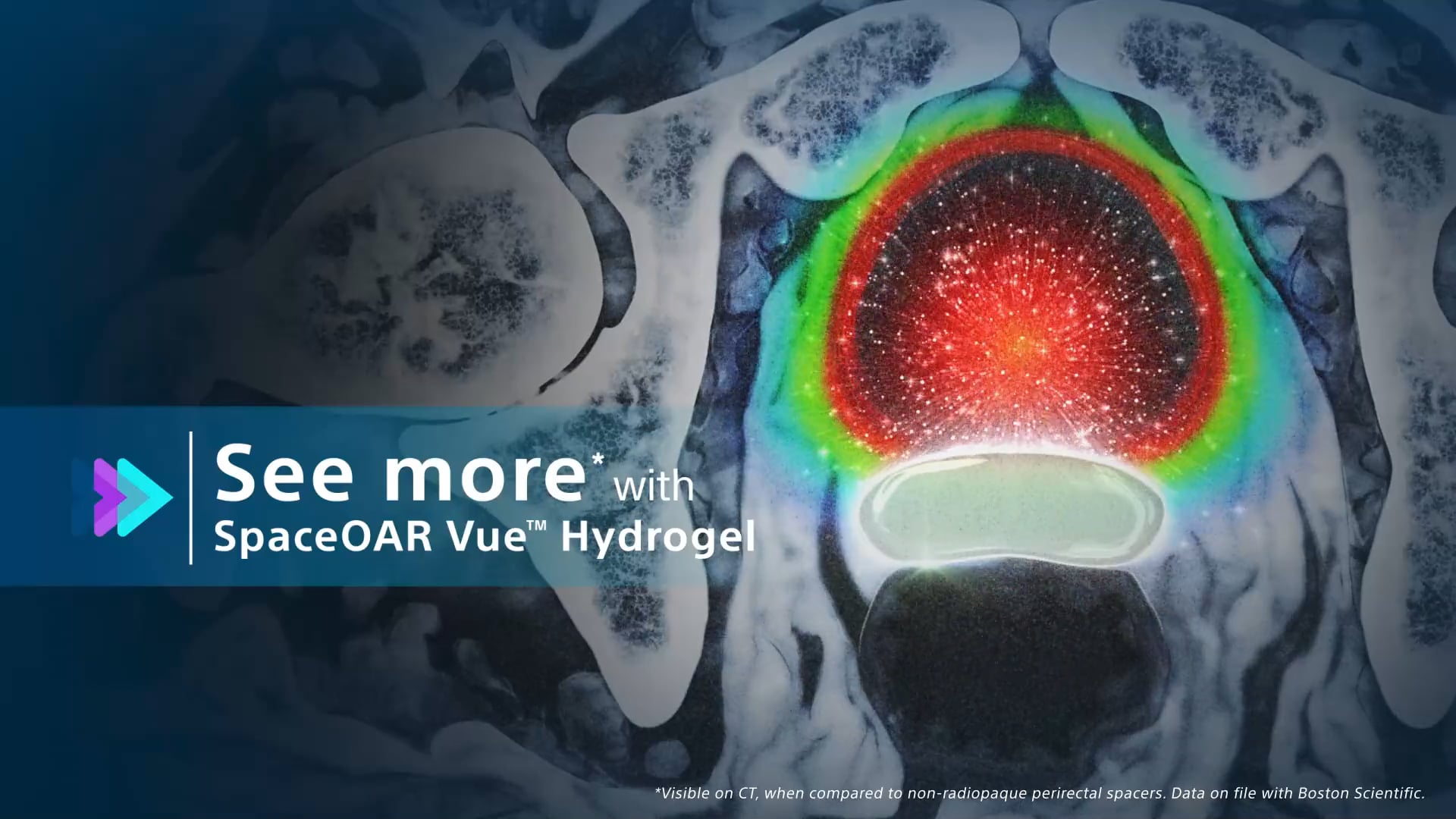 See more* with SpaceOAR Vue™ Hydrogel on Vimeo