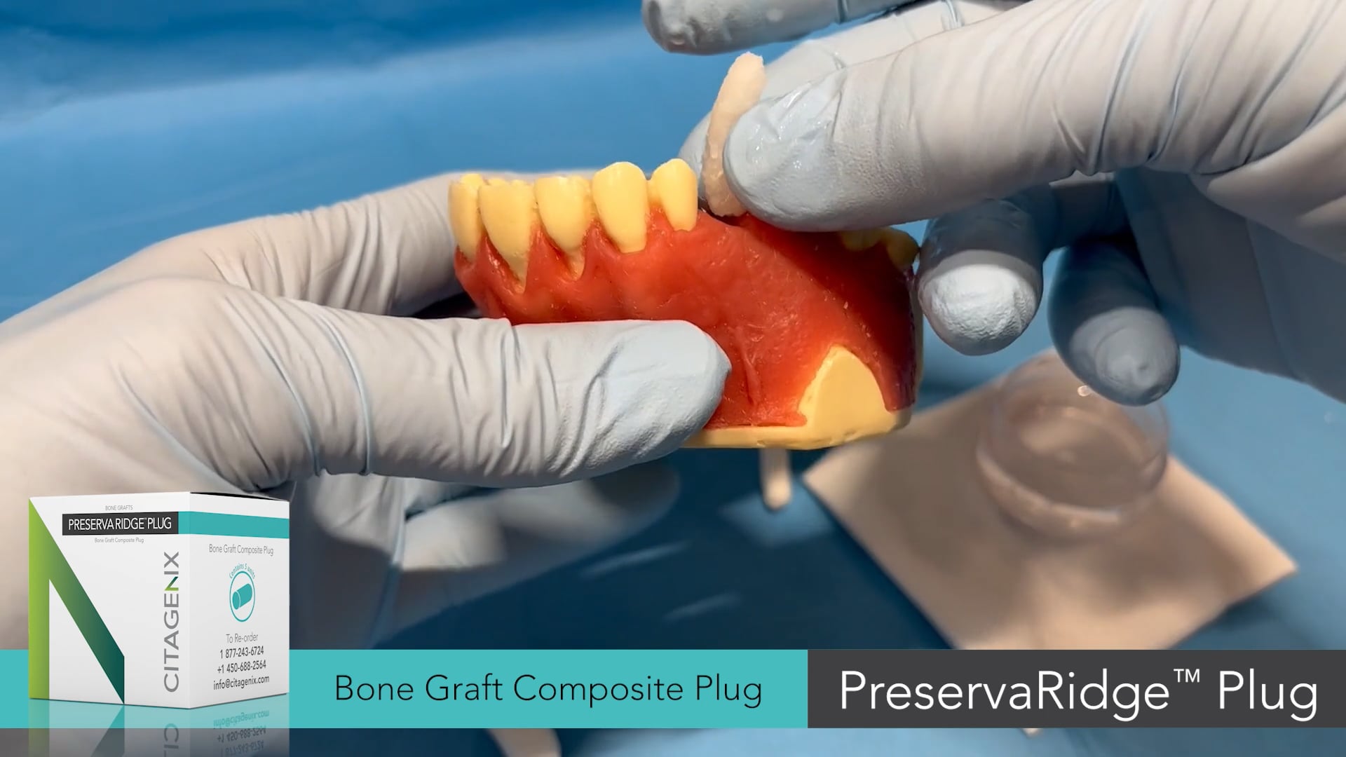 PreservaRidge Plug | Product presentation on Vimeo