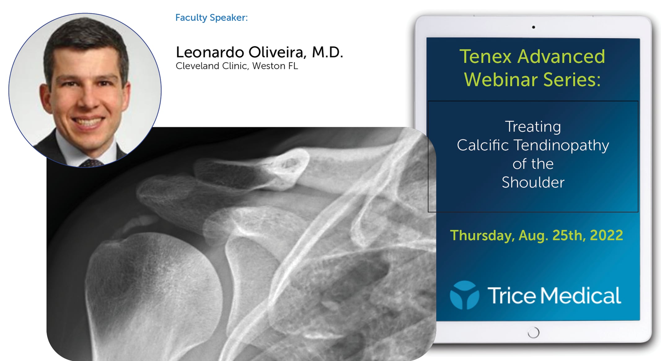 Tenex: Calcific Tendinopathy of the Shoulder with Dr Leonardo Oliveira ...