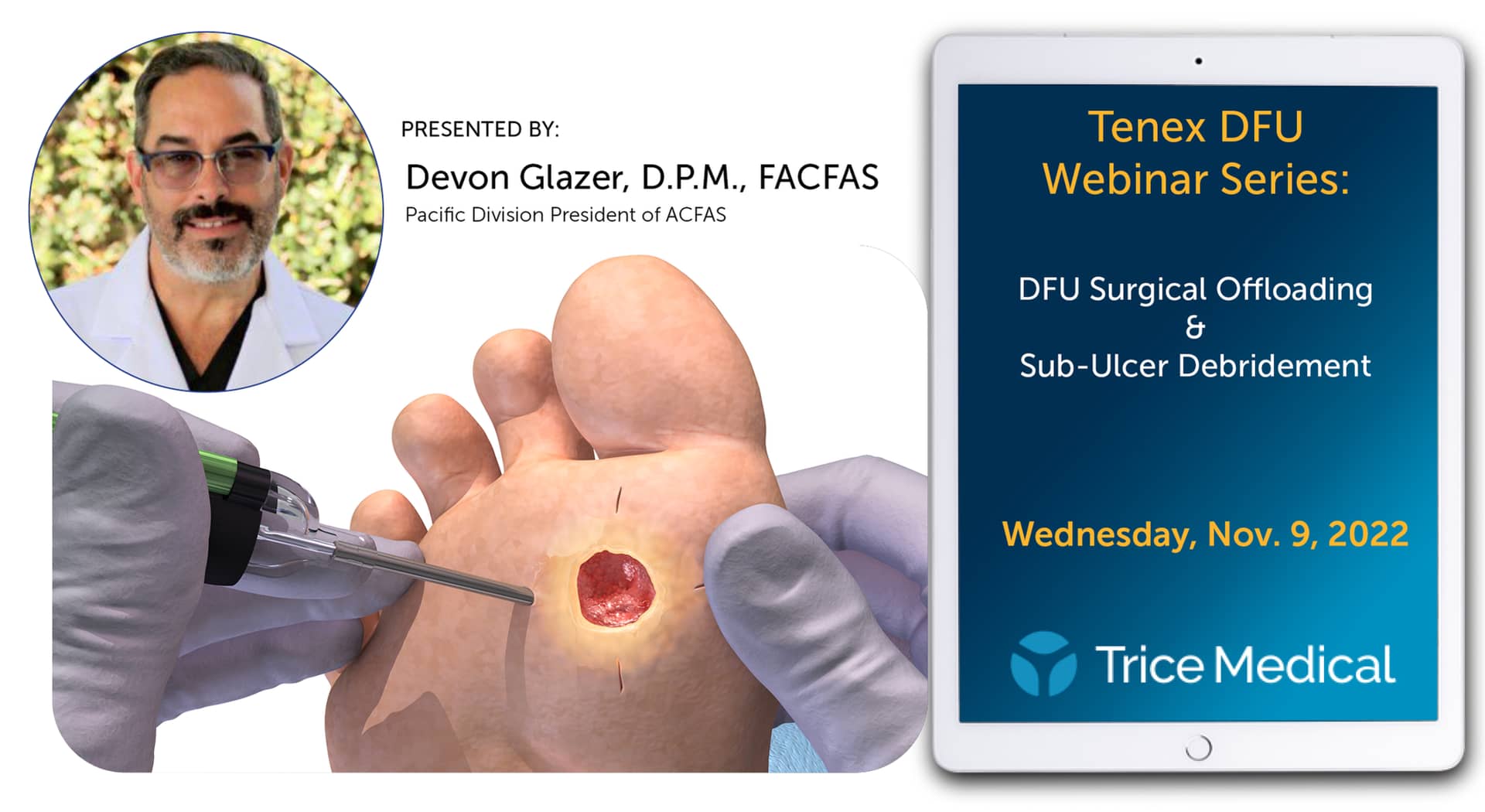 Tenex DFU: Surgical Offloading & Sub-Ulcer Debridement with Dr. Devon ...