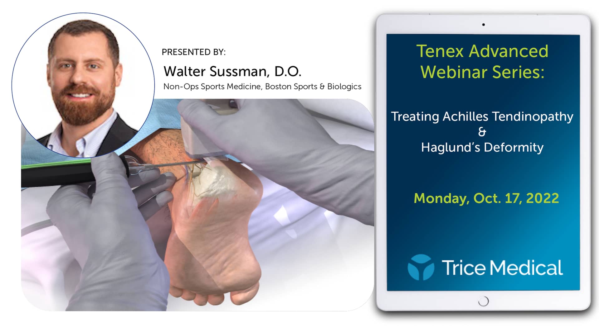 Tenex: Achilles Tendinopathy and Haglund's Deformities with Dr. Walter ...