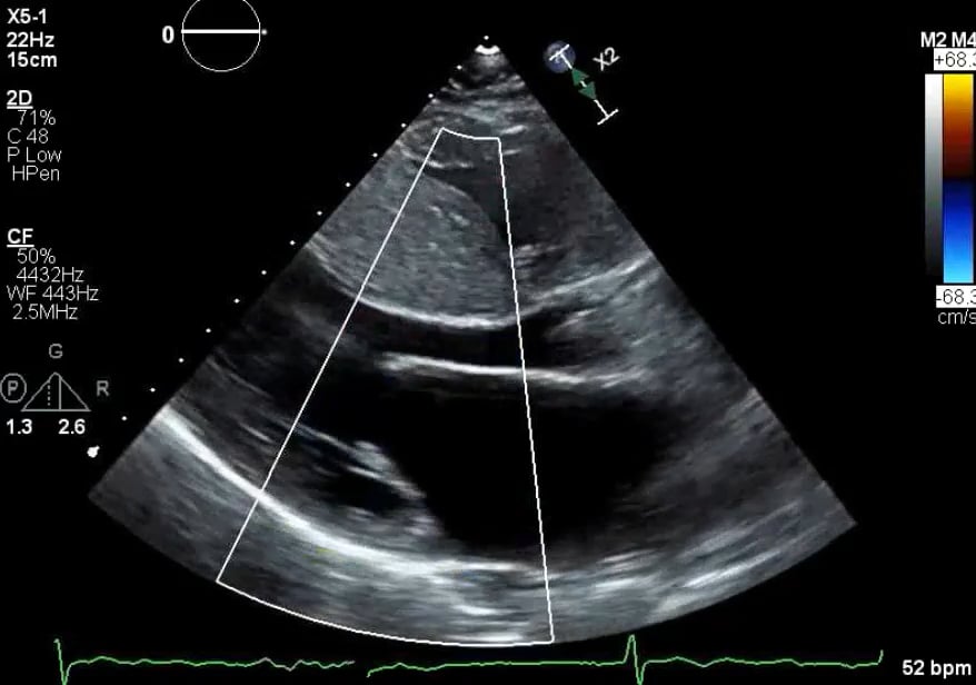 ACC Cardio - Lección 4 Vídeo 2 on Vimeo