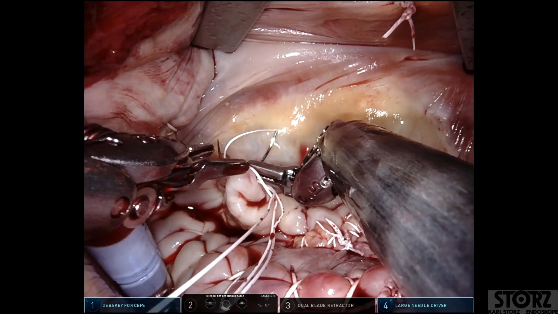 A robotic-assisted approach to sliding plasty, neochordoplasty, and ...