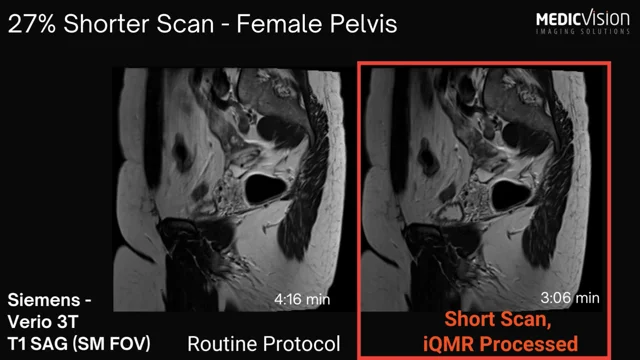 Normal Female Pelvic Mri