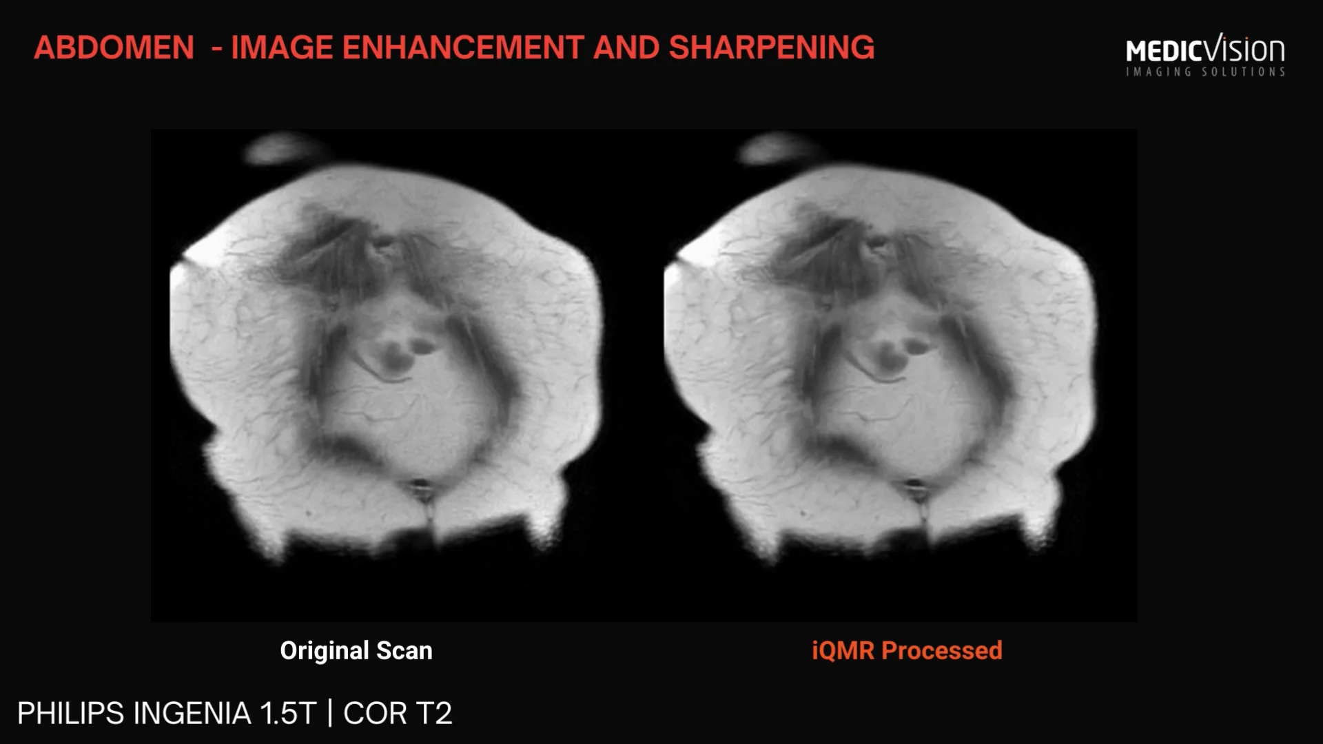 Enhancing 1.5T MRI abdomen images to 3T quality. Philips INGENIA 1.5T ...