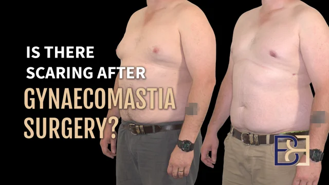 Gynecomastia Before And After Scar