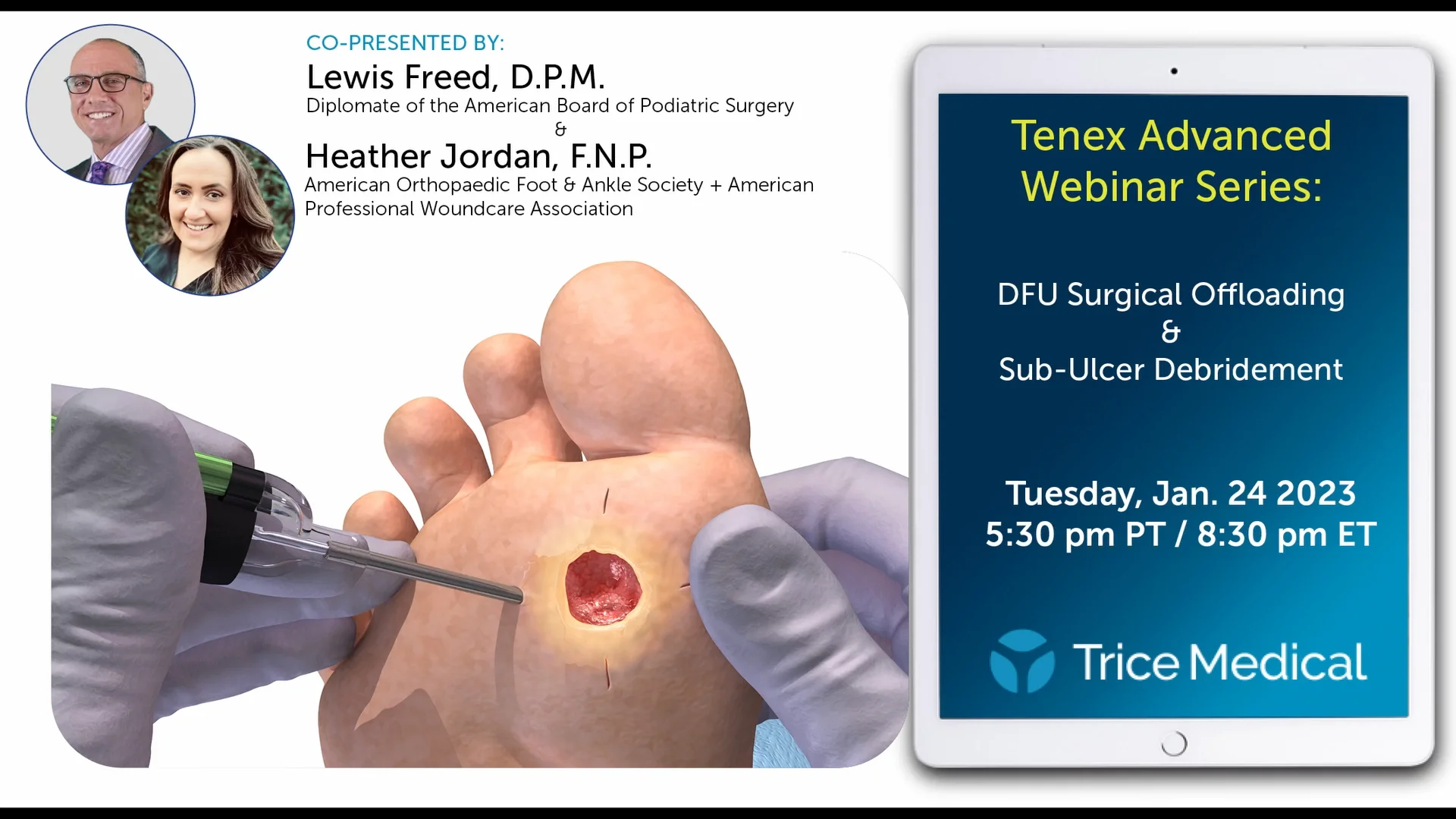 Tenex DFU: Surgical Off-Loading and Sub-Ulcer Debridement
