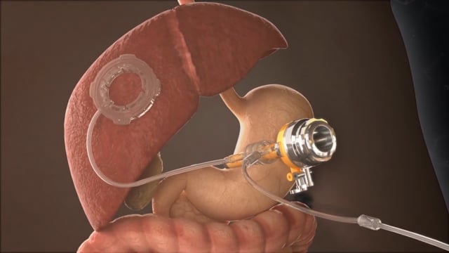 LiVac RETRACTOR SYSTEM on Vimeo