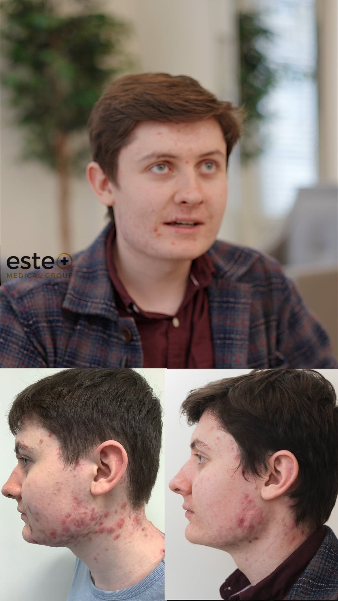 Adam's Acne Treatments - Este Medical