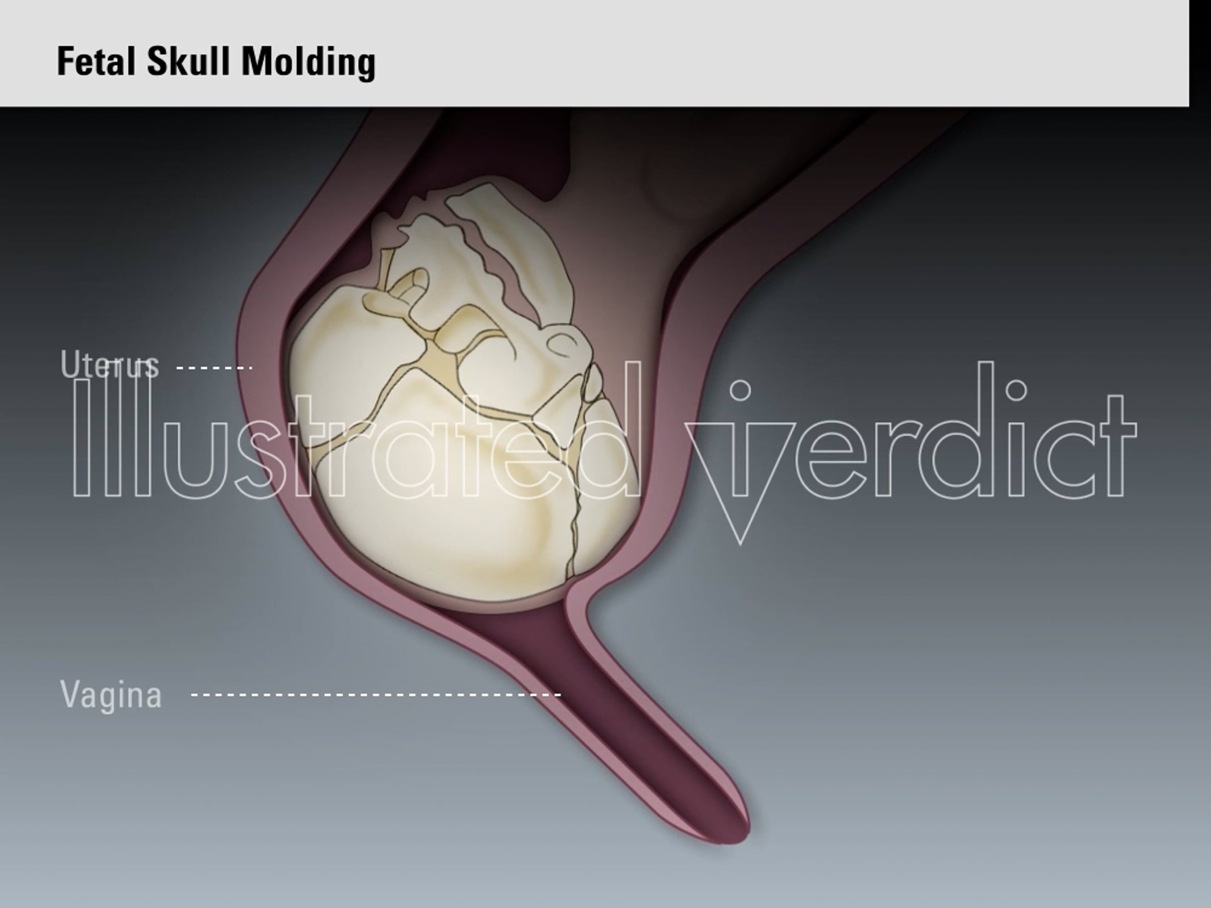 fetal-skull-molding-with-caput