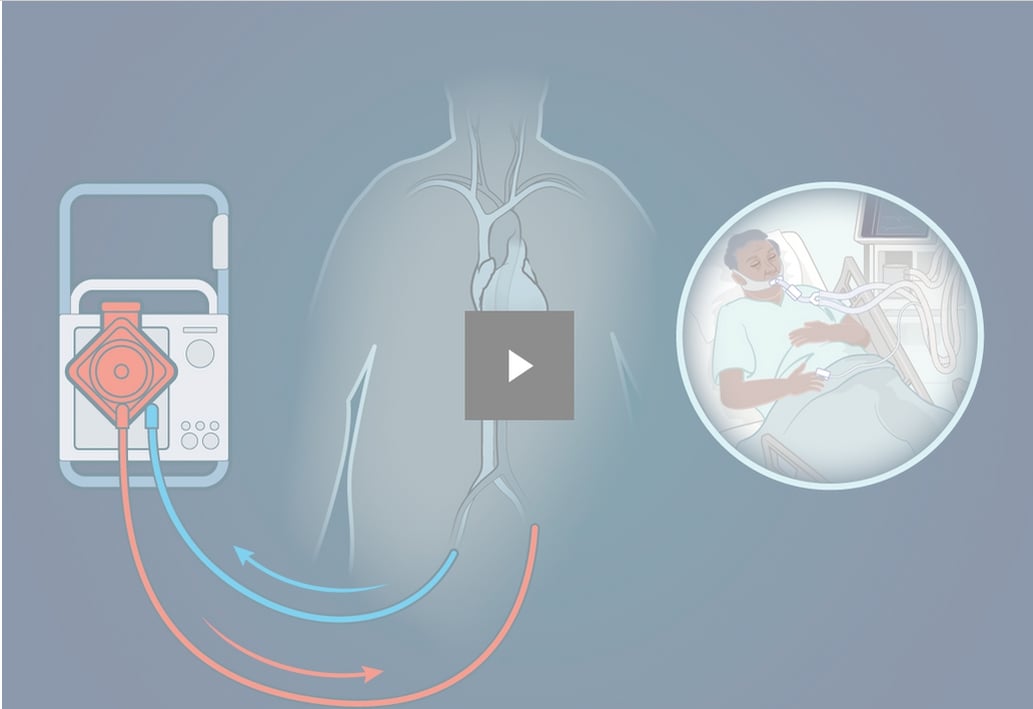 Extracorporeal CPR for Refractory Cardiac Arrest NEJM (1).mp4 on Vimeo