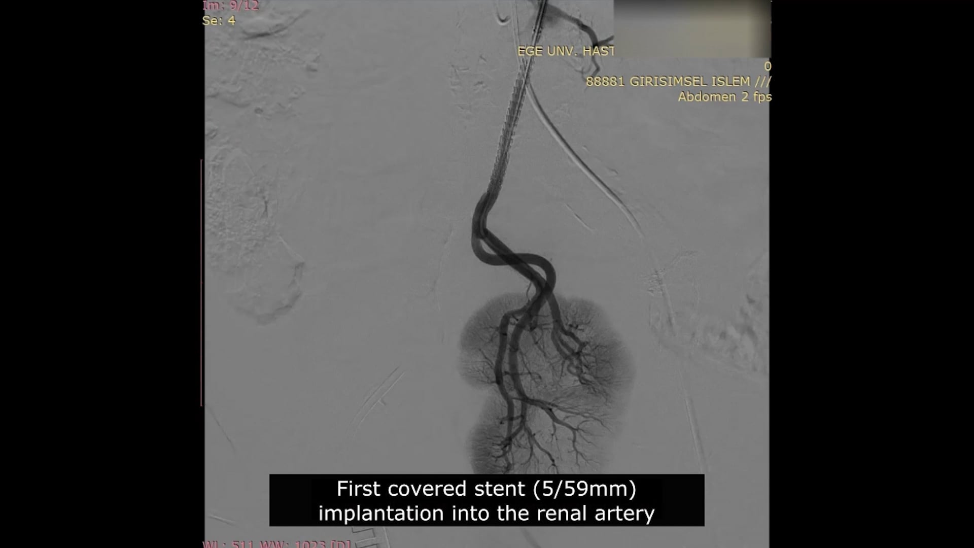 Chimney technique for a solitary pelvic kidney | MMCTS