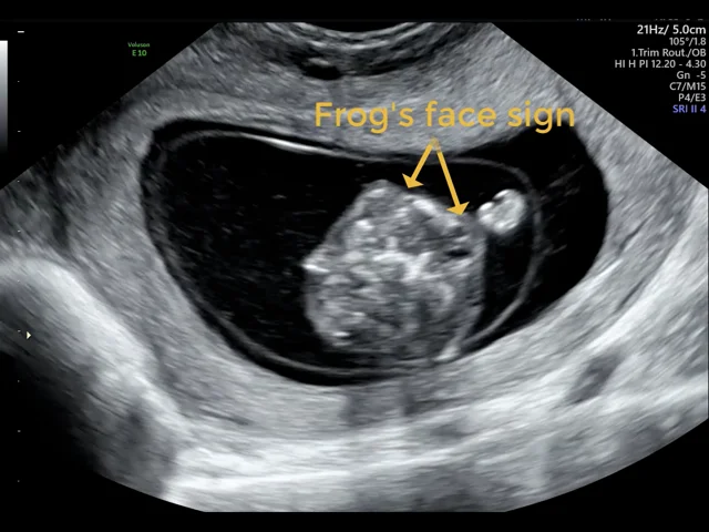 Anencephaly Ultrasound Findings