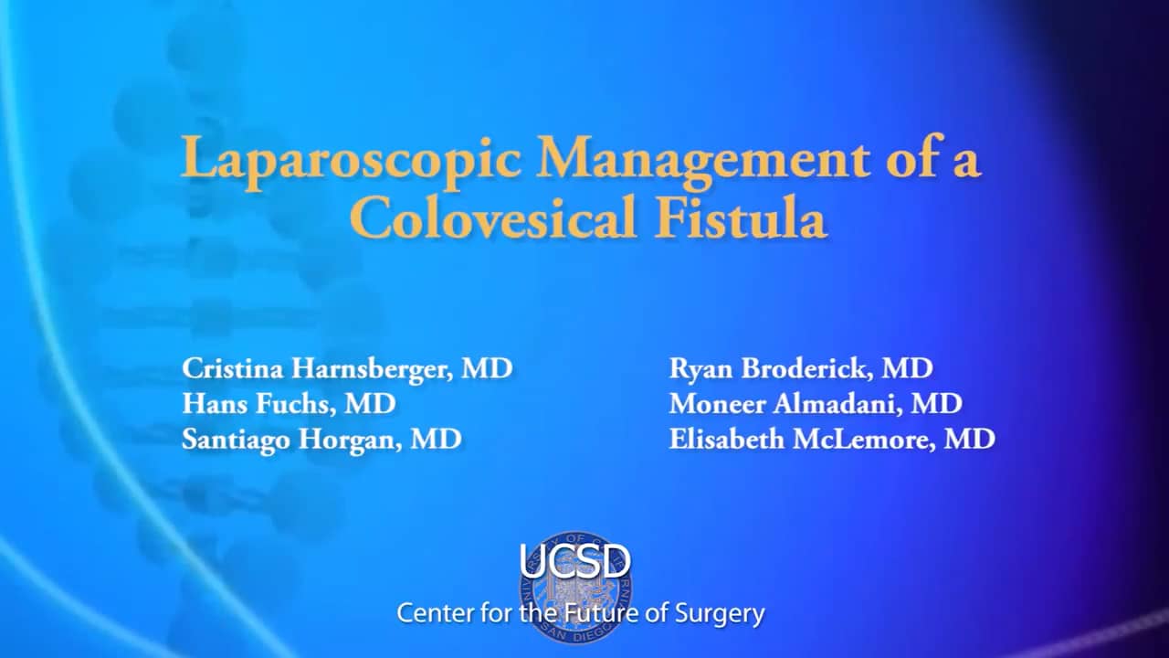 V010 LAPAROSCOPIC MANAGEMENT OF A COLOVESICAL FISTULA.mp4 on Vimeo