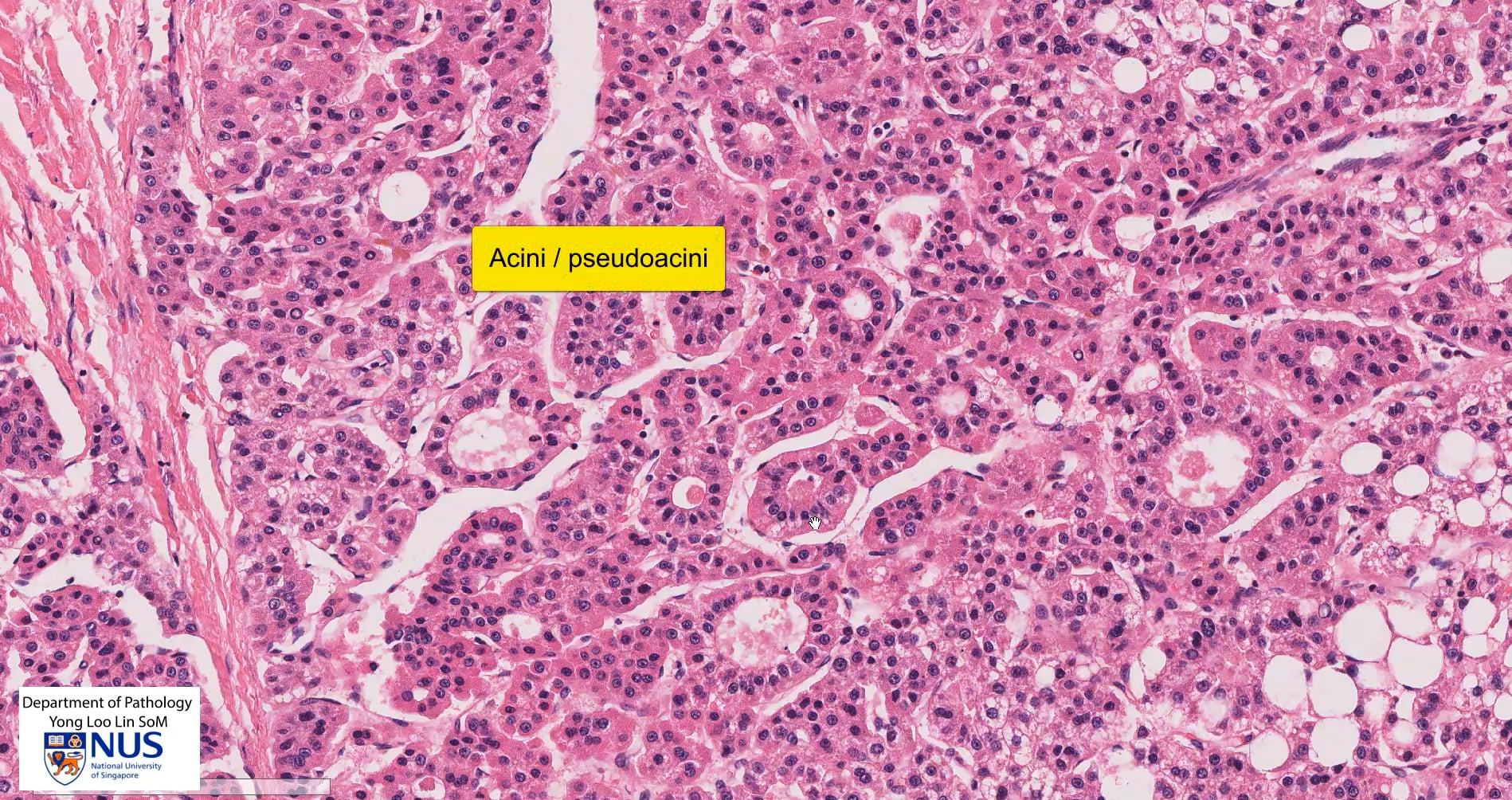 Liver Hepatocellular carcinoma Microscopy - Talking slide on Vimeo