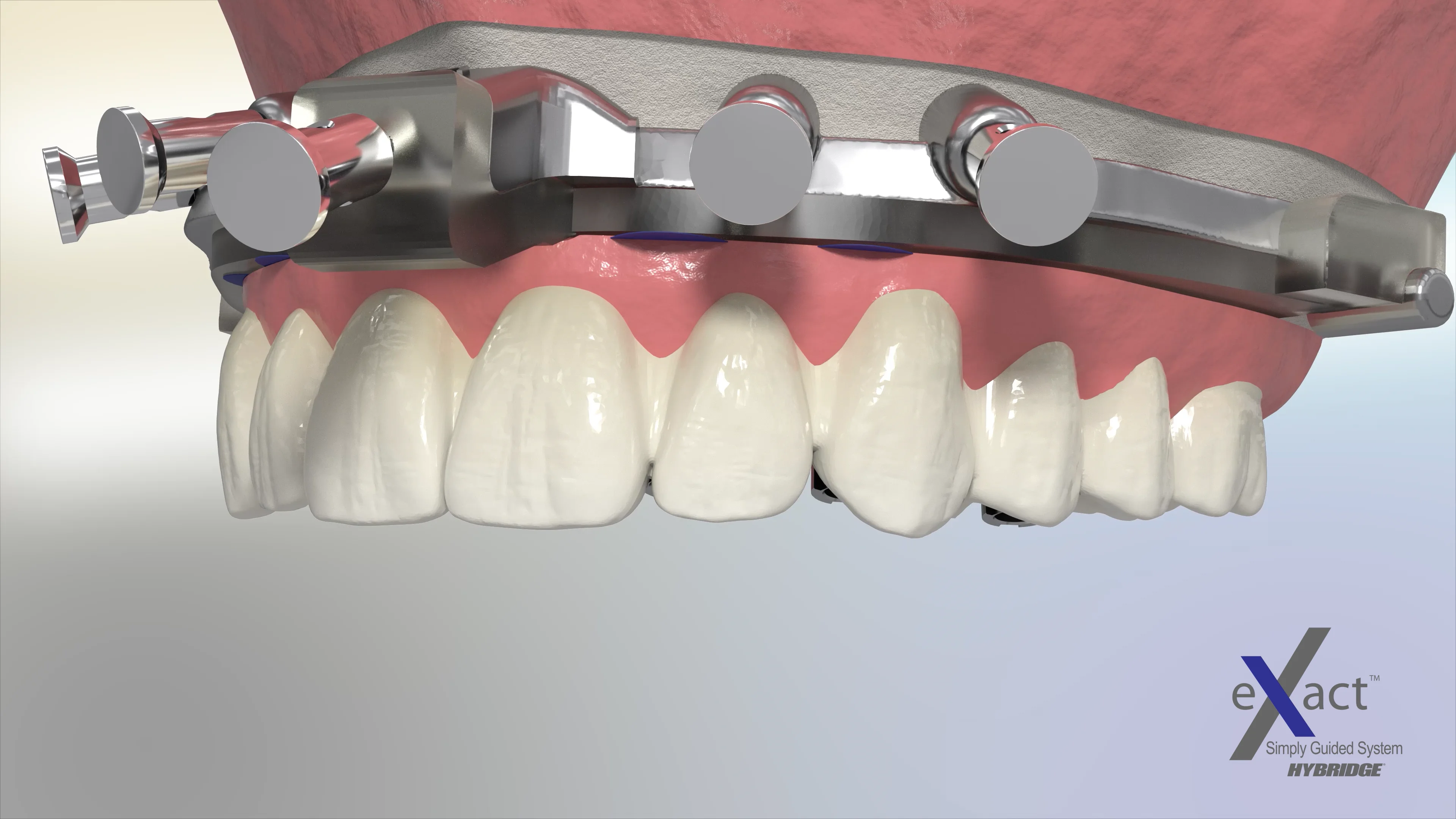eXact XD Simply Guided Full Arch Surgical System 4K