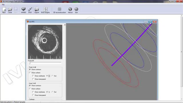 Demonstration of the new 3D features of IVUS-ANGIO Tool on Vimeo