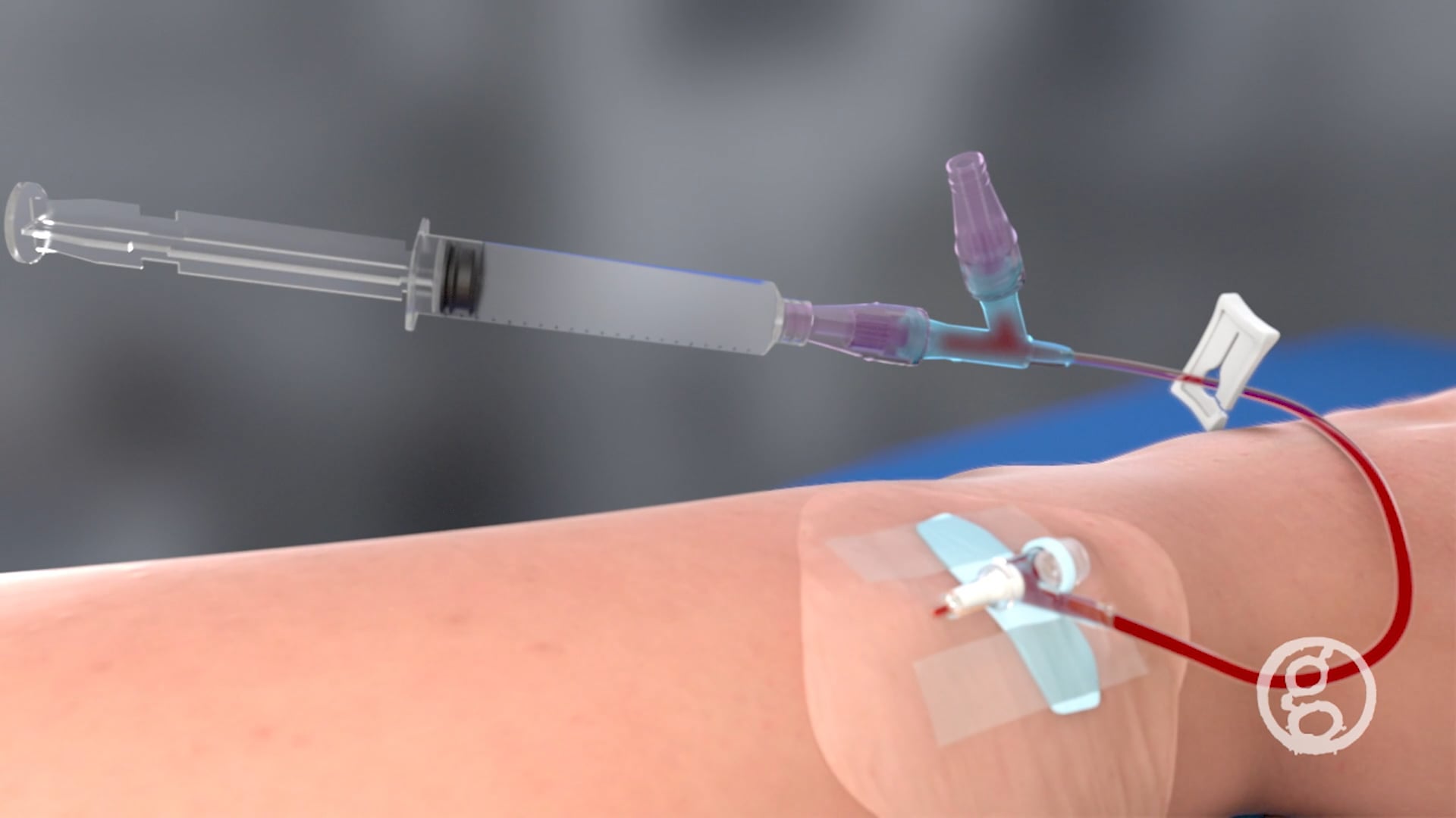 Smiths Medical DeltaVen® Closed System Catheter