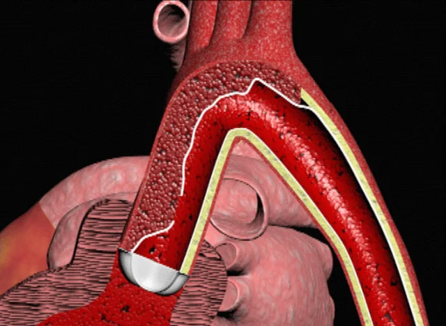 Aortic Dissection Cross Section