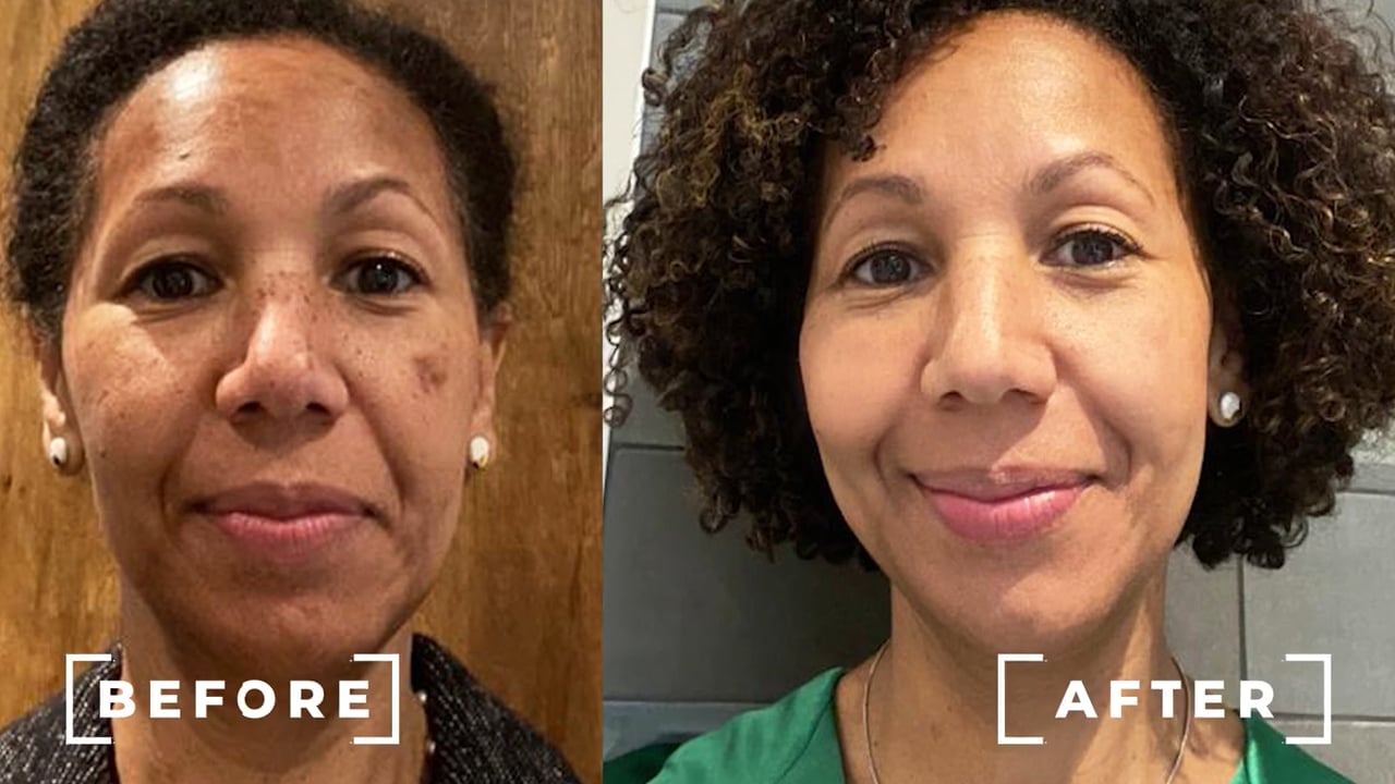 Pure Plasma THE FUTURE OF SKIN REJUVENATION HAS ARRIVED.mp4