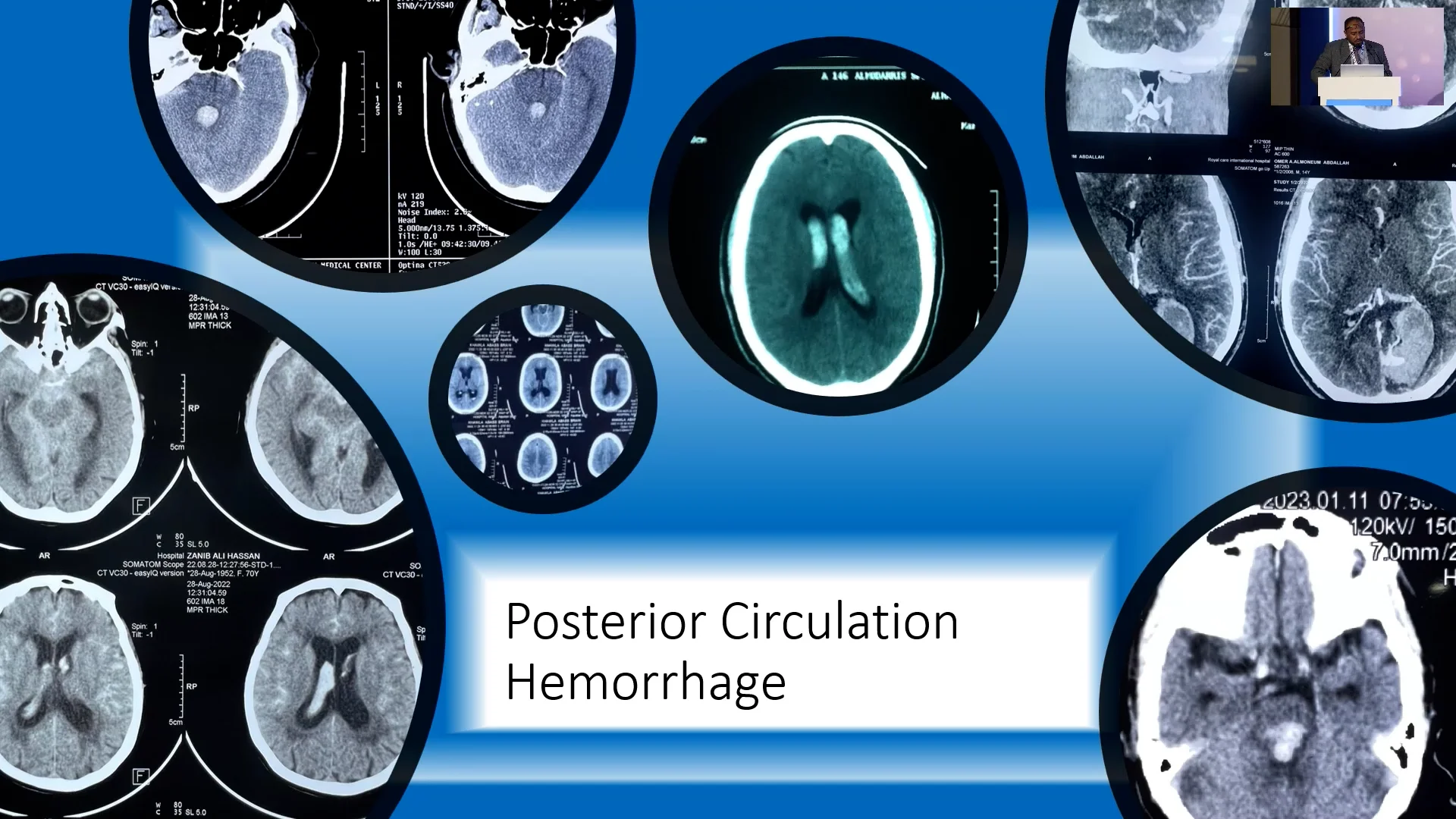 Posterior Circulation Hemorrhage - Mohamed Tyfor (Sudan) on Vimeo
