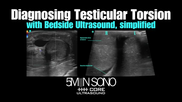 Testicular Torsion