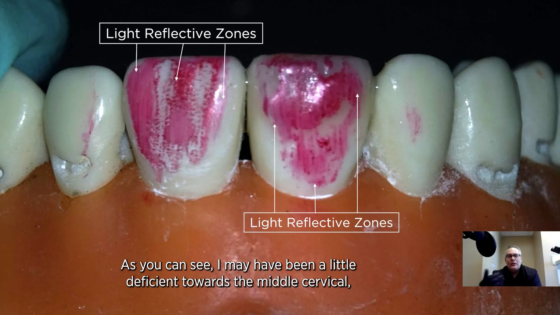 Using Articulating Paper to Determine Needed Texture on Your Composite ...
