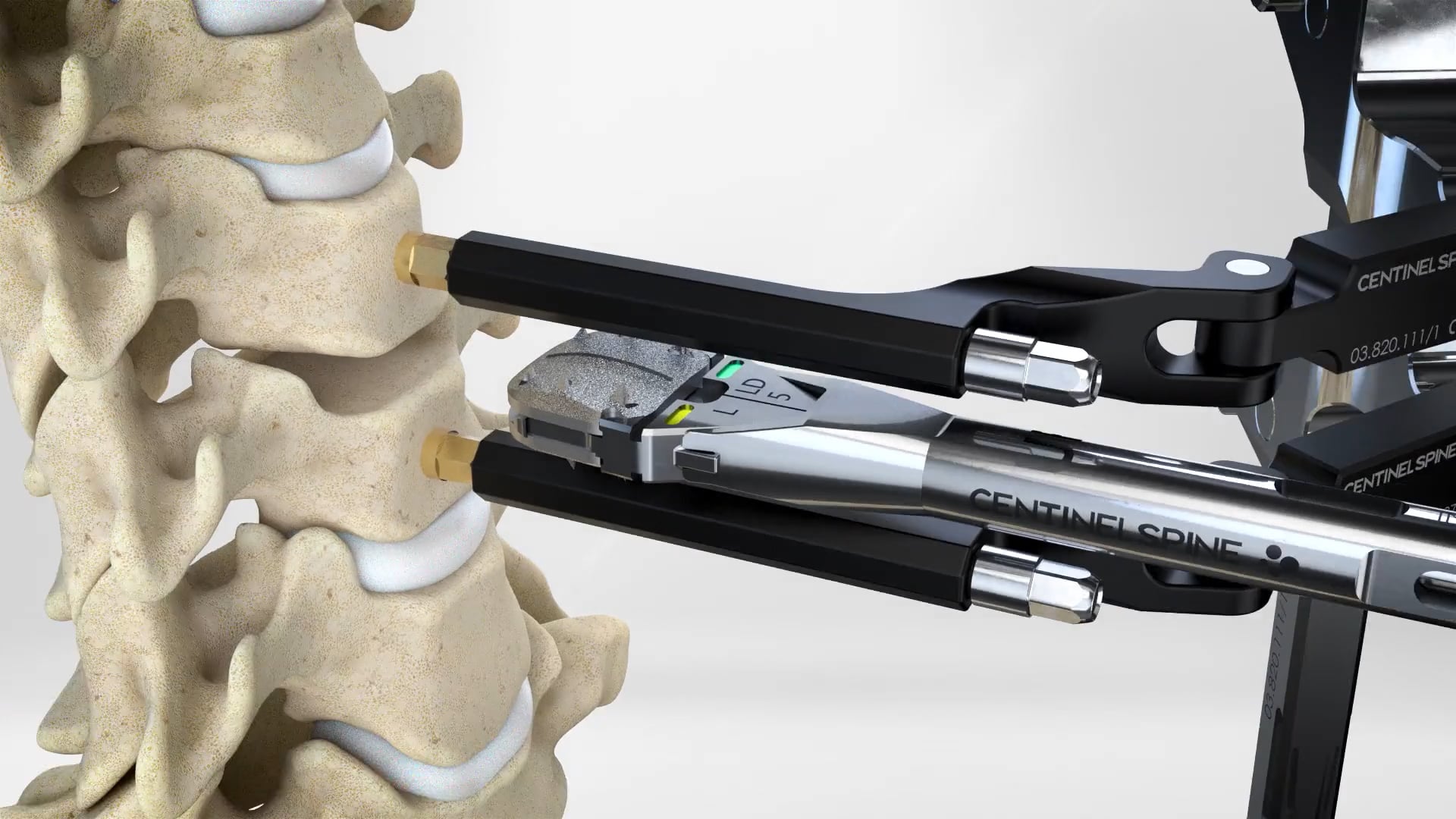 Centinel Spine Videos - prodisc C Vivo Surgical Technique with prodisc ...