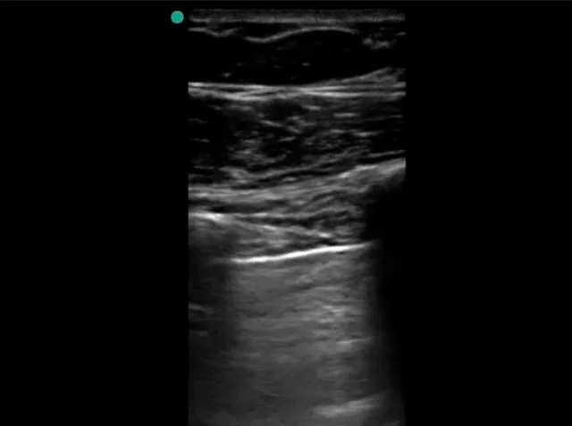Curvilinear Probe Ultrasound Slide