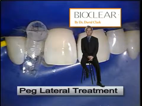 Bioclear Veneers - Fixing Peg Laterals on Vimeo