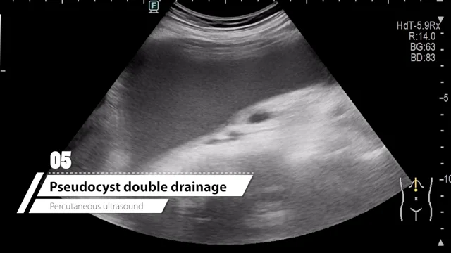 Pancreatic Pseudocyst Ultrasound